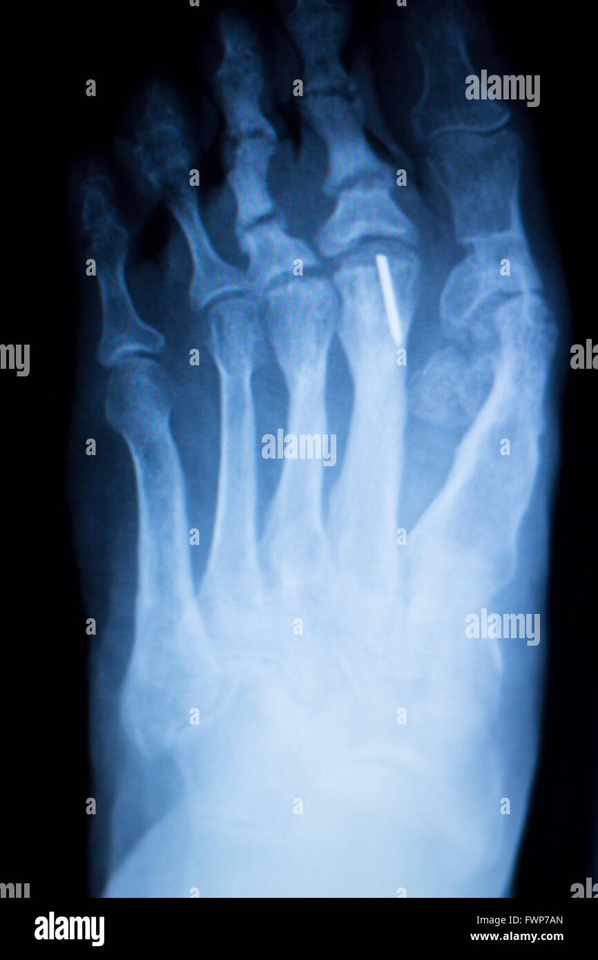 Foot and toes medical x-ray test scan result for adult showing ...