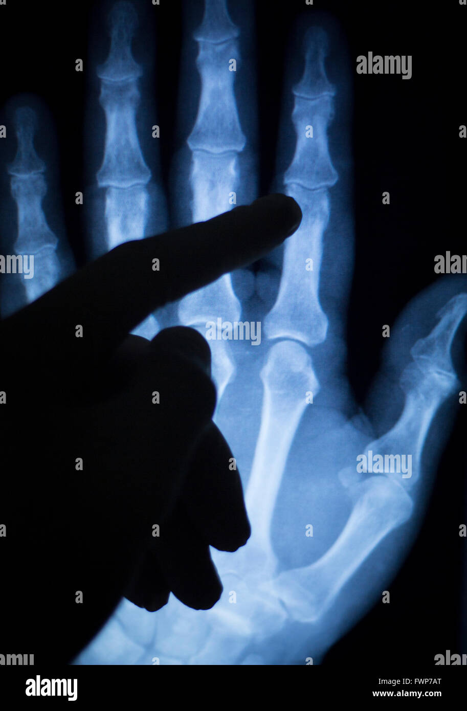 Wrist, hand injury medical x-ray test scan result for adult image Stock ...