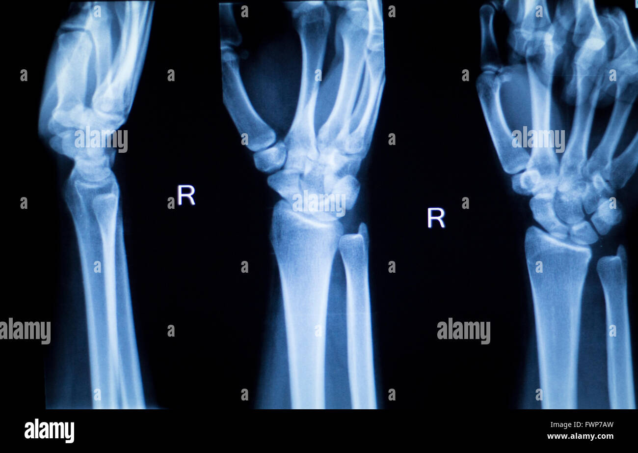 Sprained Wrist X Ray