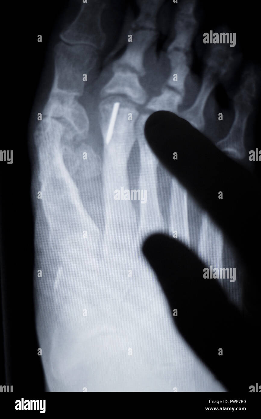 Foot and toes medical x-ray test scan result for adult showing ...