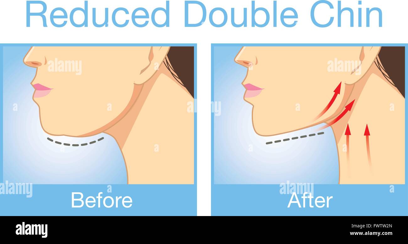 Reduce a double chin Stock Vector Image & Art - Alamy