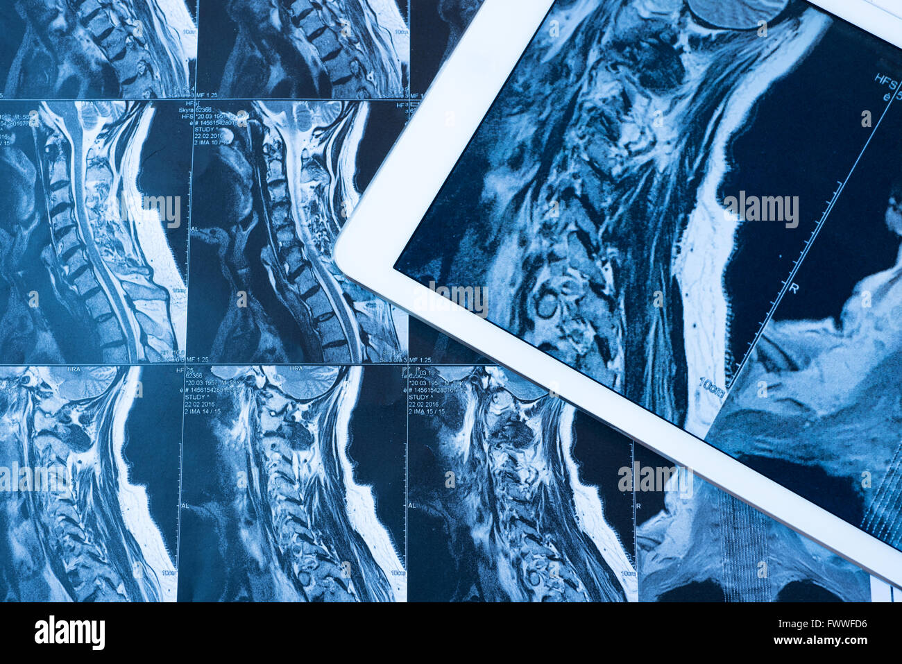 MRI Pictures of spinal column with magnification on overlaying tablet ...