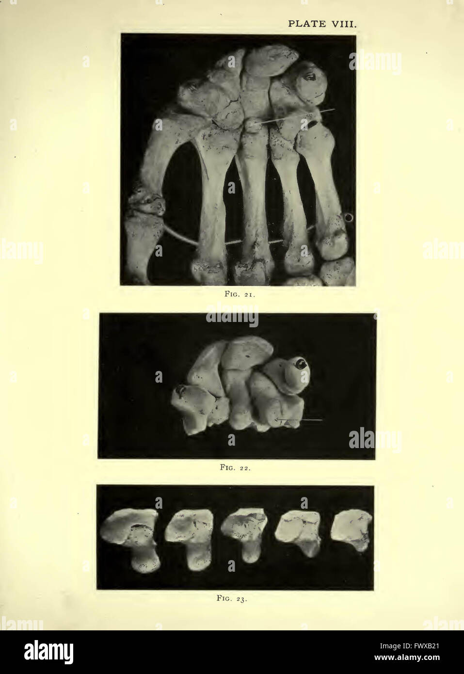 Variations of the bones of the hands and feet by Dwight, Thomas, 1843 ...