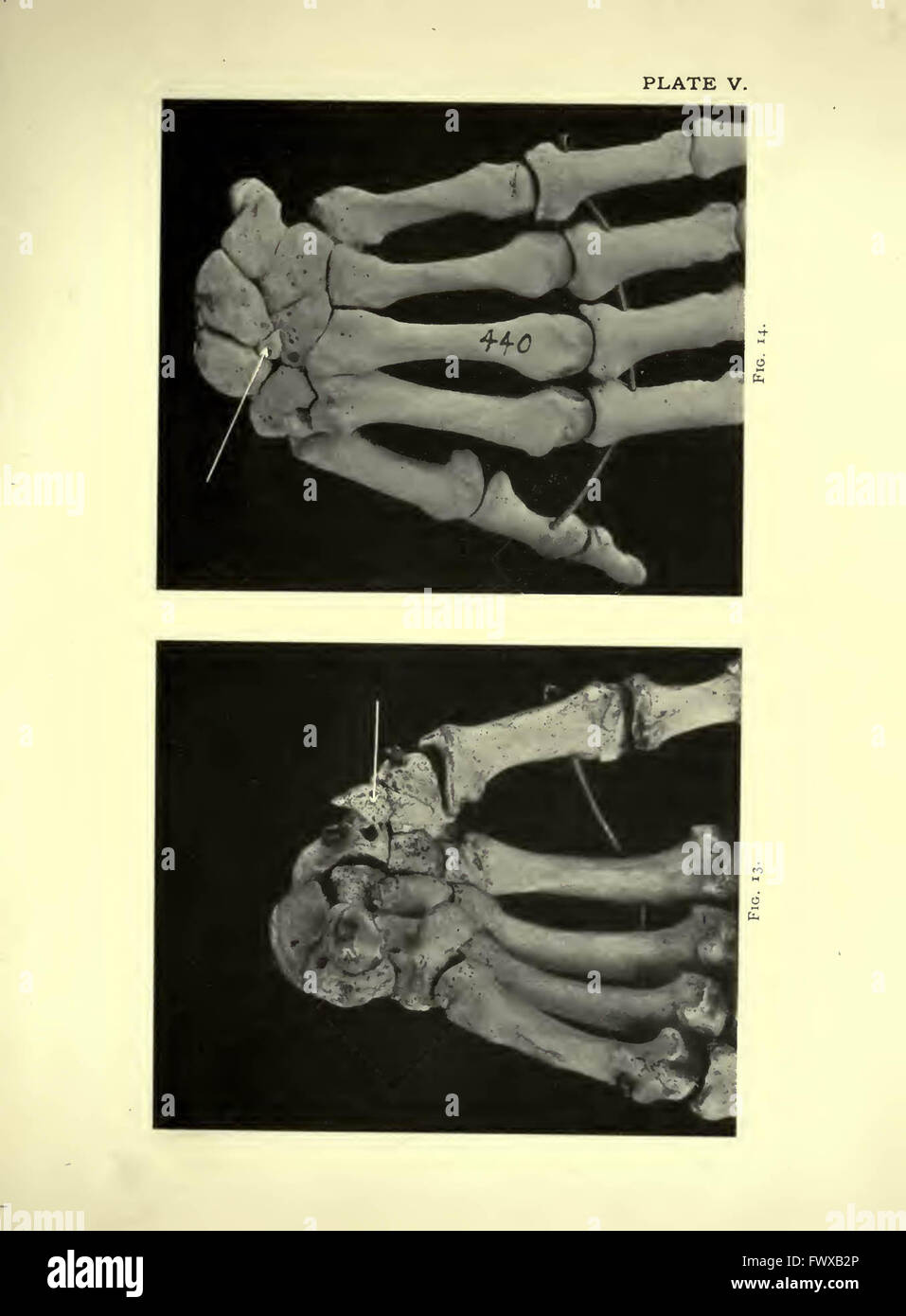 Variations of the bones of the hands and feet by Dwight, Thomas, 1843 ...