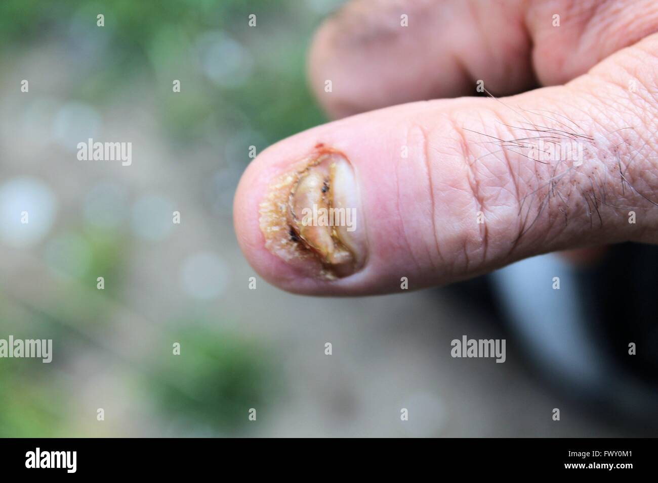 Fingernail condition hi-res stock photography and images - Alamy
