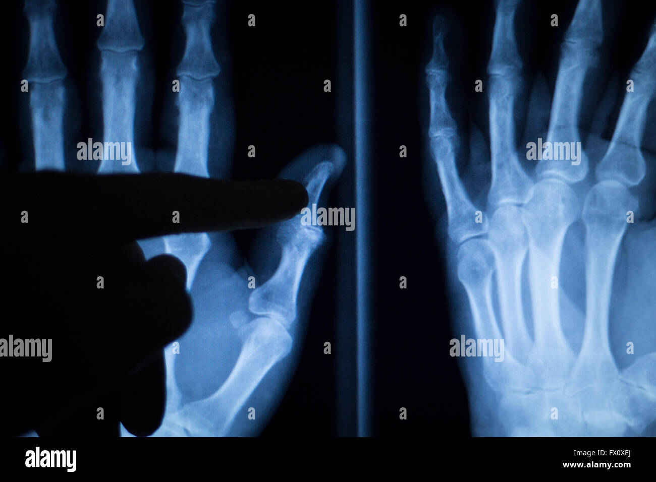 Broken Hand Scan