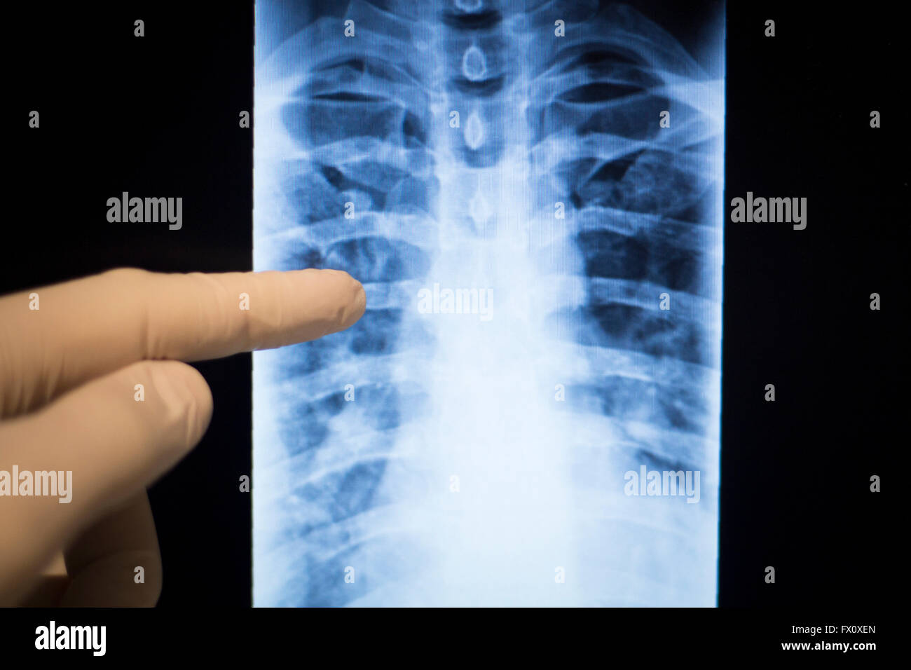 Spinal column, vertebra, neck and back medical x-ray test scan result ...