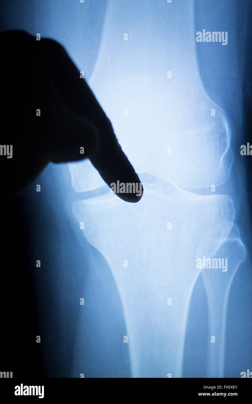 Knee and meniscus injury medical x-ray test scan result for adult ...