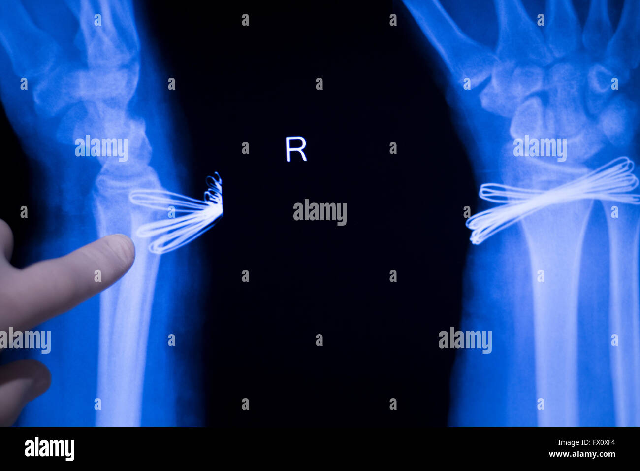 Wrist, hand, forearm and arm injury medical x-ray test scan result for ...
