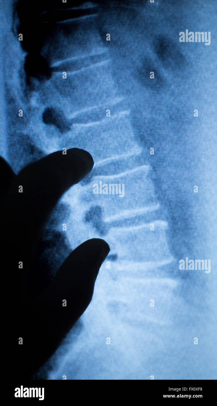 Spinal column, vertebra, neck and back medical x-ray test scan result ...