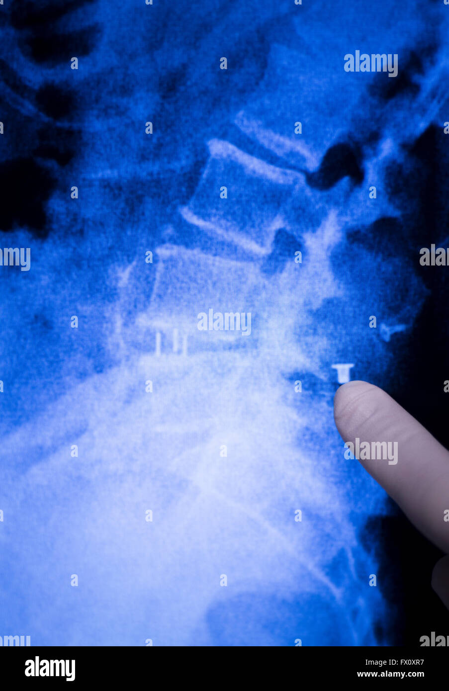 Spinal implant hi-res stock photography and images - Alamy