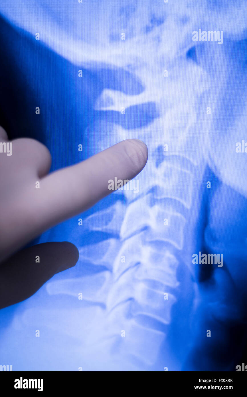 Spinal implant hi-res stock photography and images - Alamy