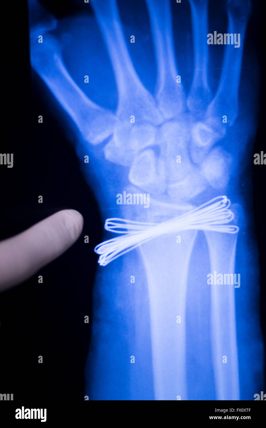 Wrist, hand, forearm and arm injury medical x-ray test scan result for ...