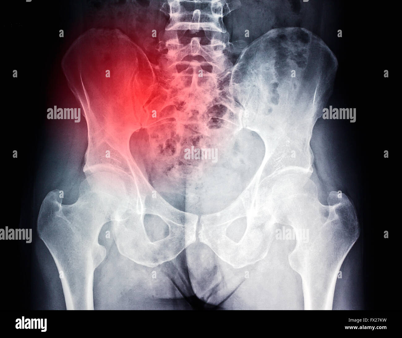 X-ray of the pelvis with inflammation Stock Photo - Alamy