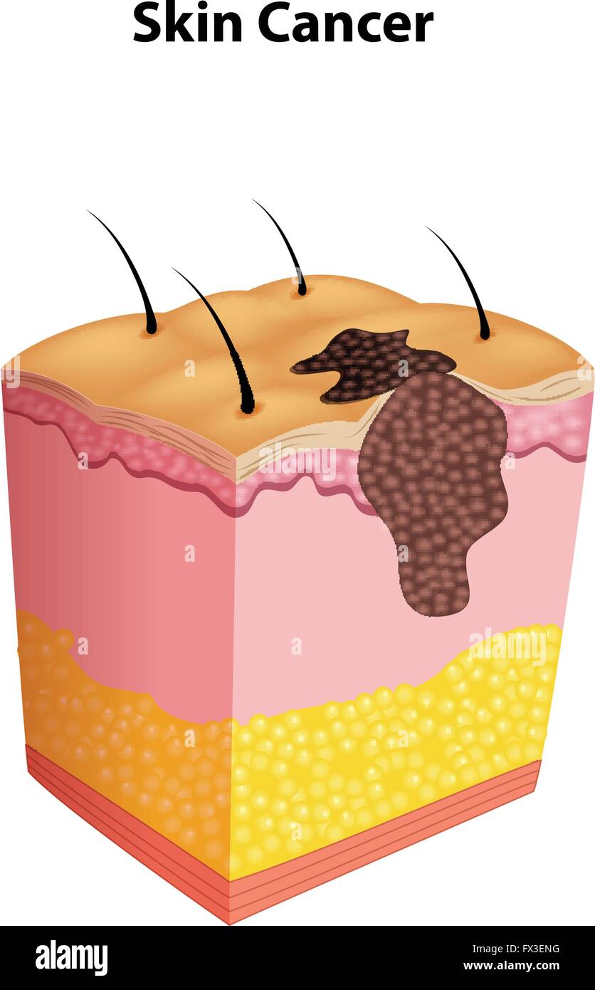 Illustration of skin cancer Stock Vector Image & Art - Alamy