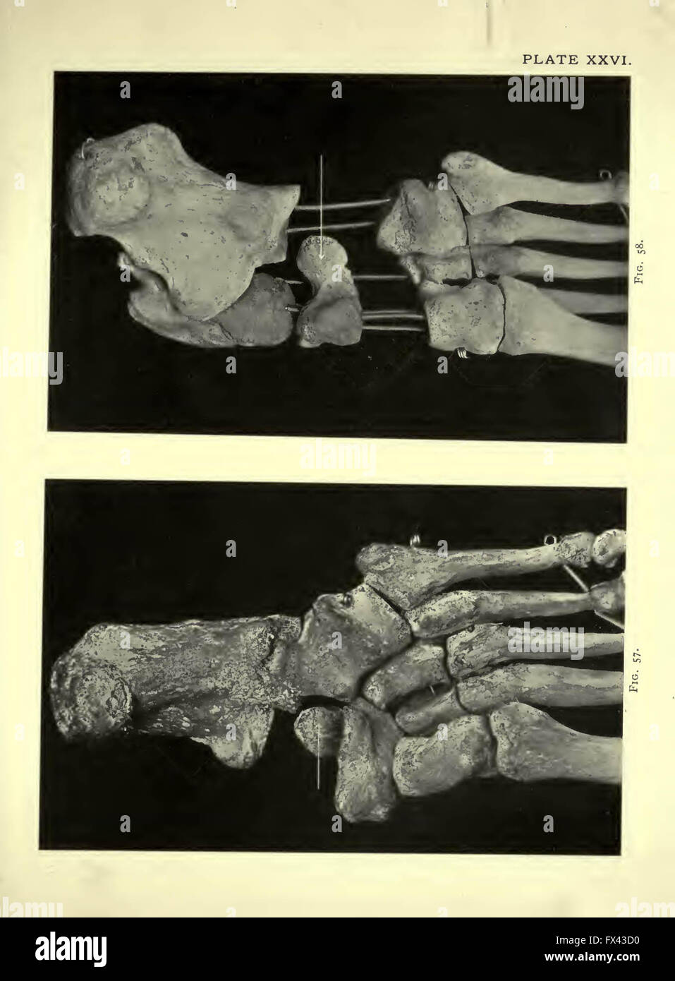 Variations of the bones of the hands and feet by Dwight, Thomas, 1843 ...