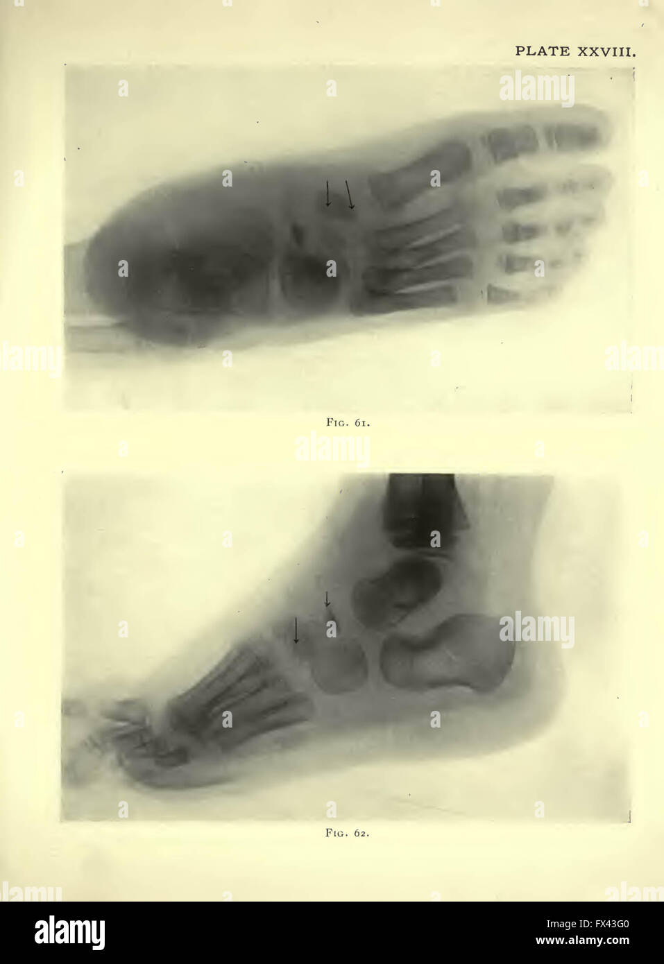 Variations of the bones of the hands and feet by Dwight, Thomas, 1843 ...