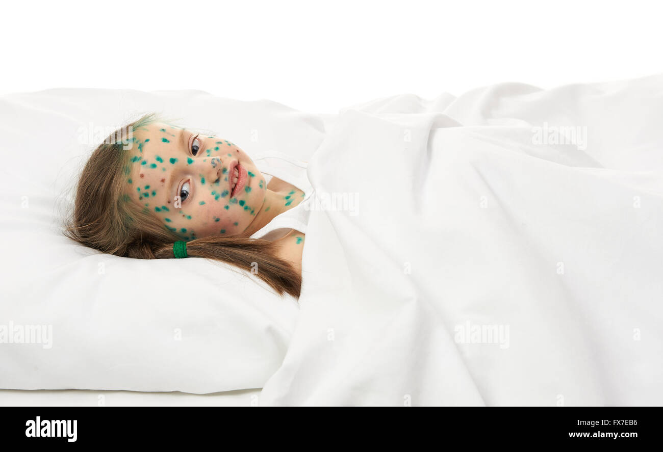 sick child has the virus on skin Stock Photo - Alamy