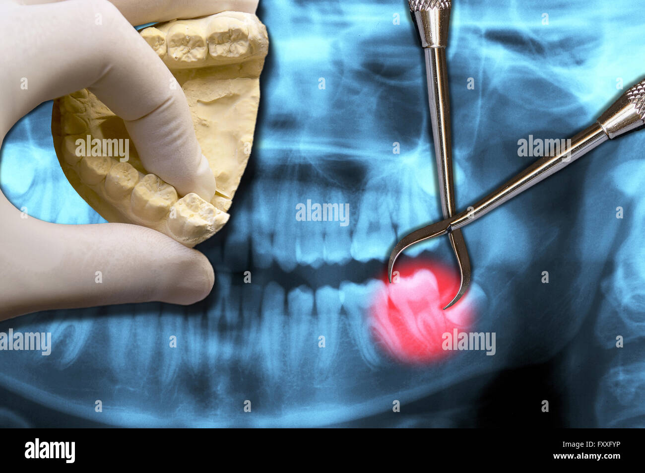dentist hand showing molar teeth over x-ray toothache wisdom and molar ...