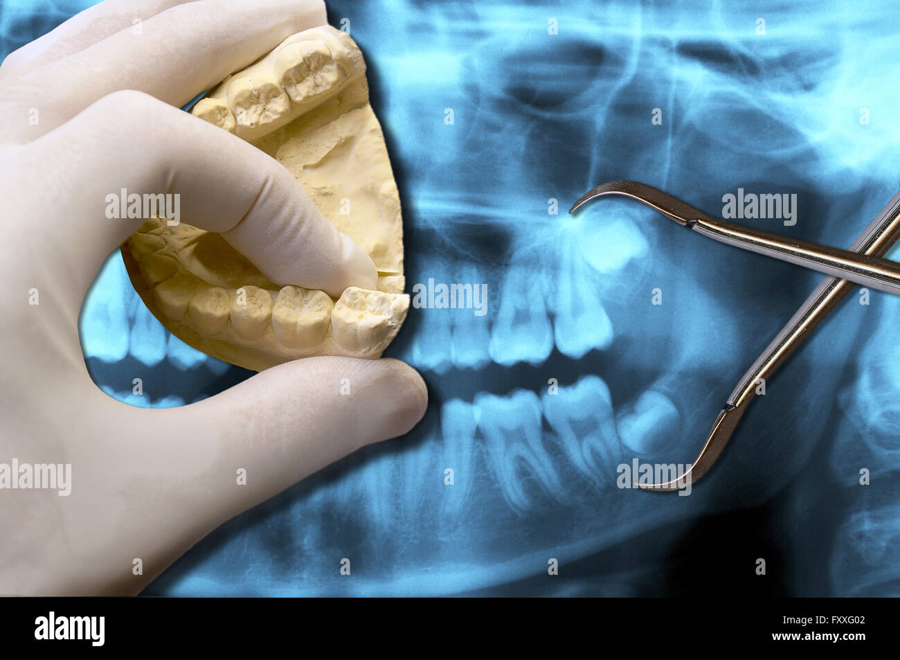 Orthodontics molar hi-res stock photography and images - Alamy