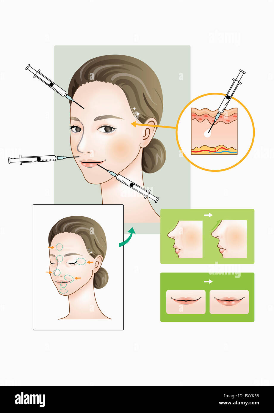 Illustration representing Botox and Filler treatment Stock Photo - Alamy