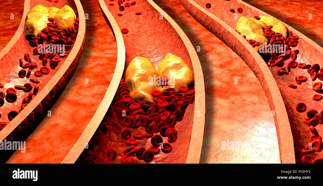 Clogged Artery with platelets and cholesterol plaque. Atherosclerosis ...