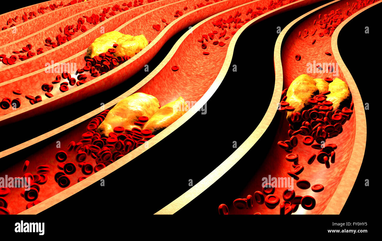 Fibrous plaque hi-res stock photography and images - Alamy