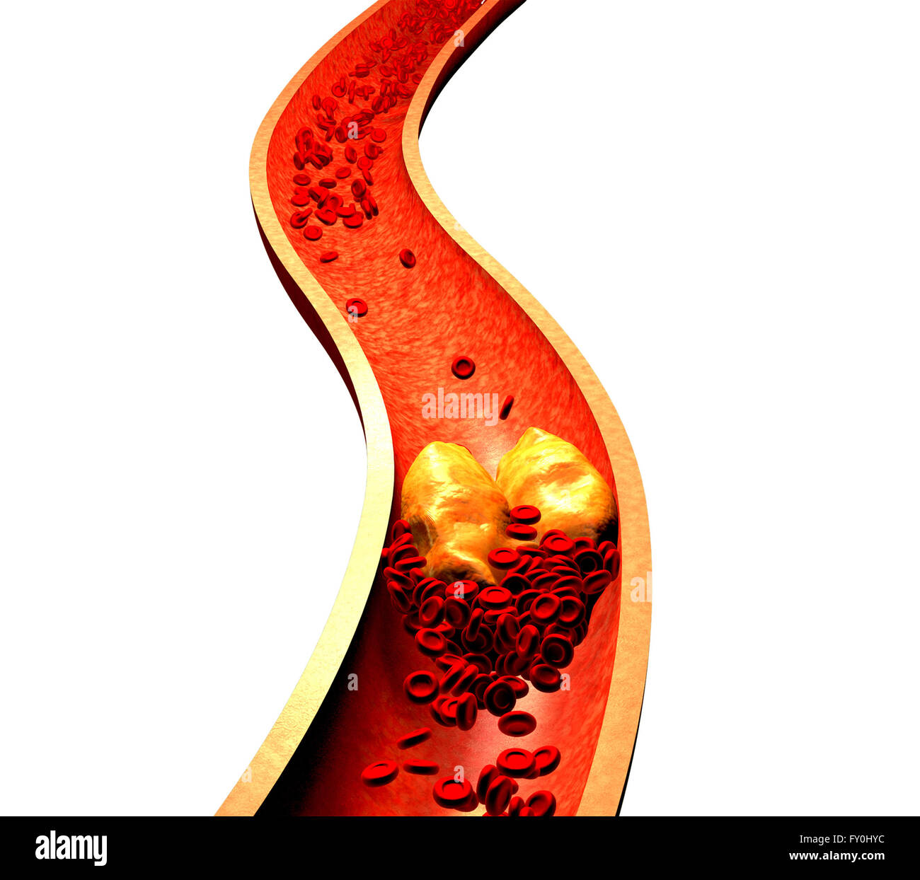 Clogged Artery with platelets and cholesterol plaque. Atherosclerosis ...