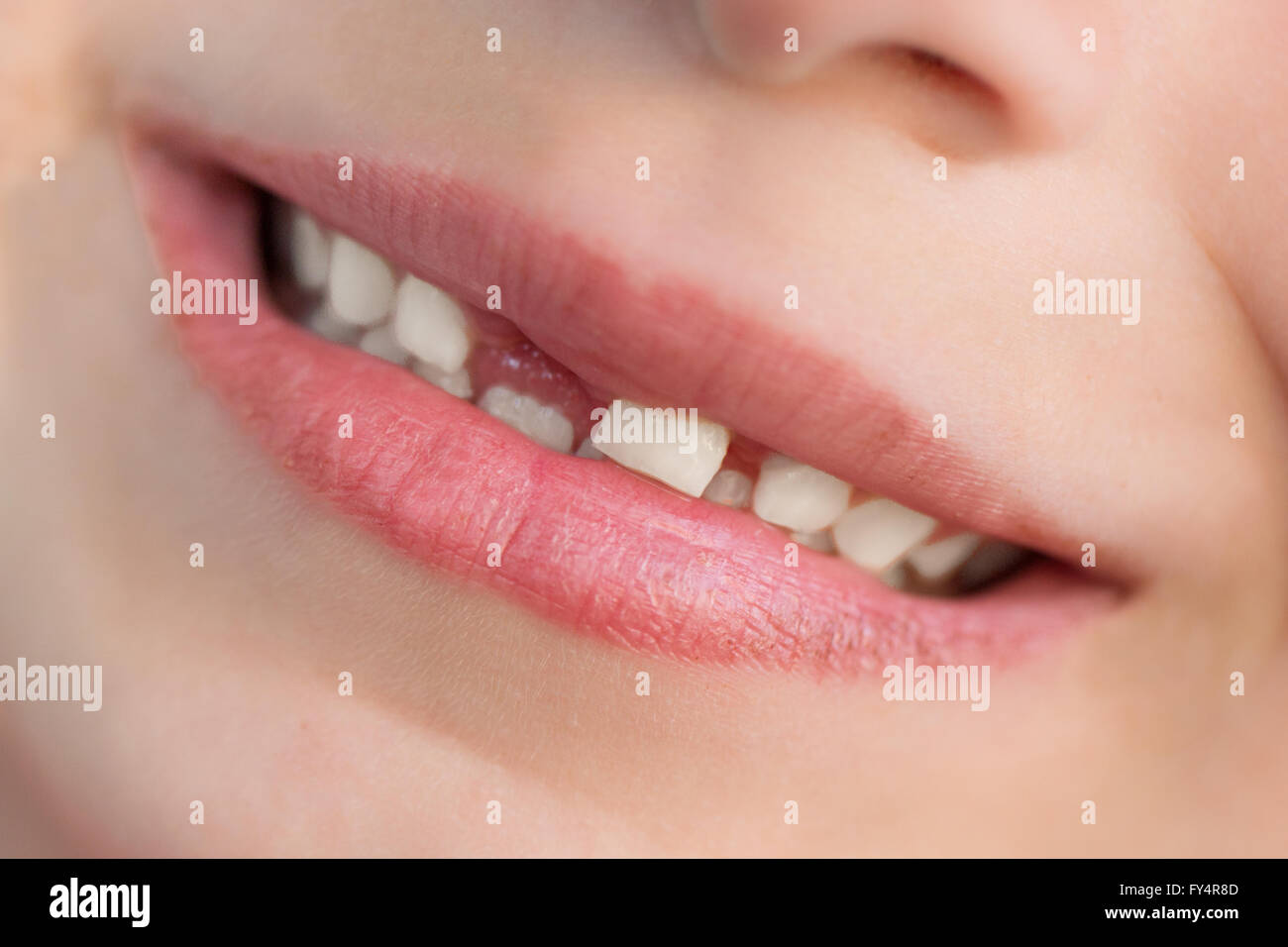 Close up of a missing tooth Stock Photo - Alamy