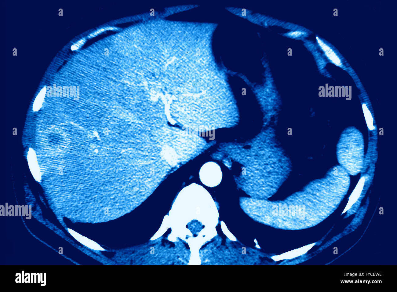 Adenopathy hi-res stock photography and images - Alamy