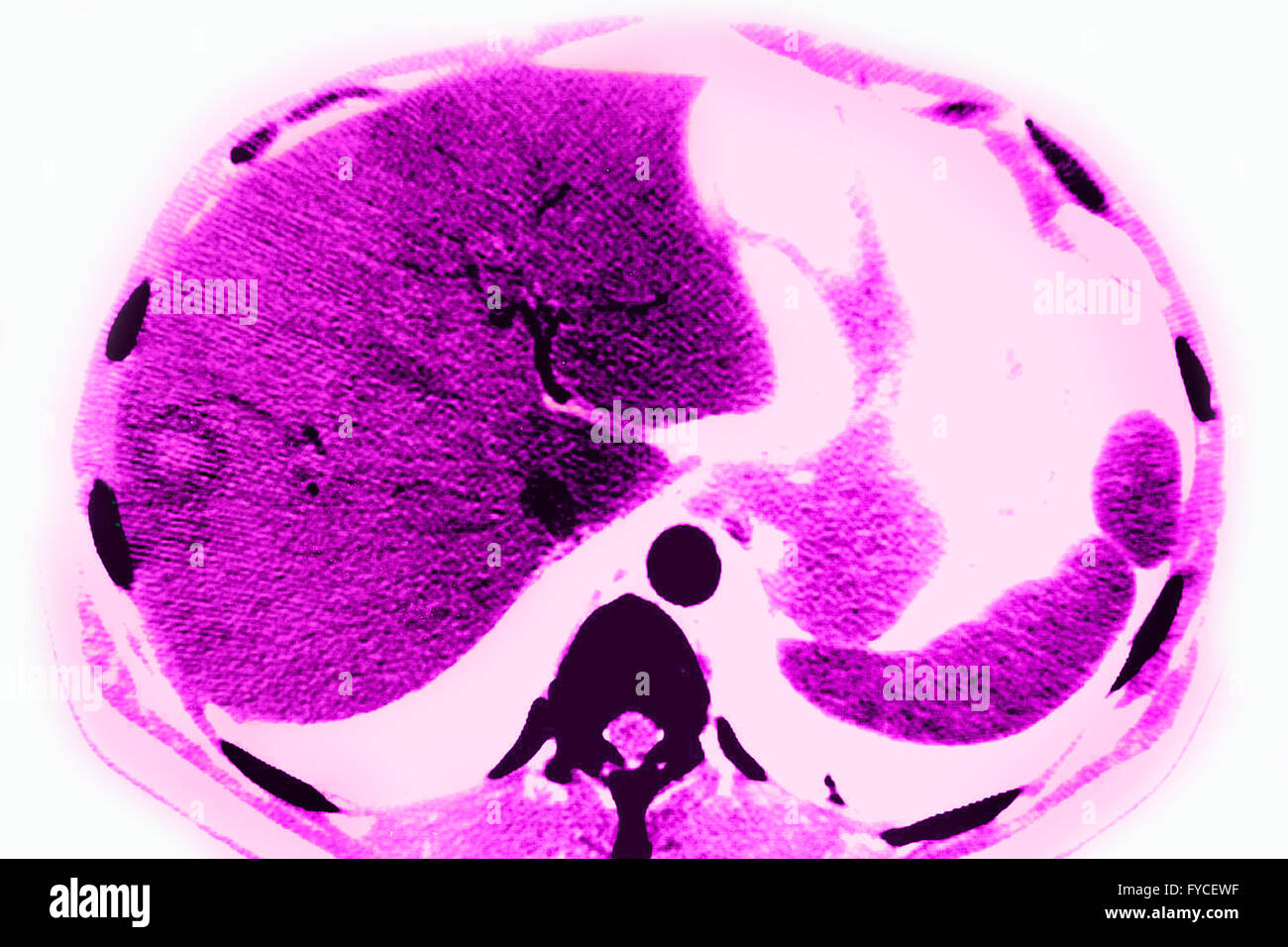 Adenopathy hi-res stock photography and images - Alamy