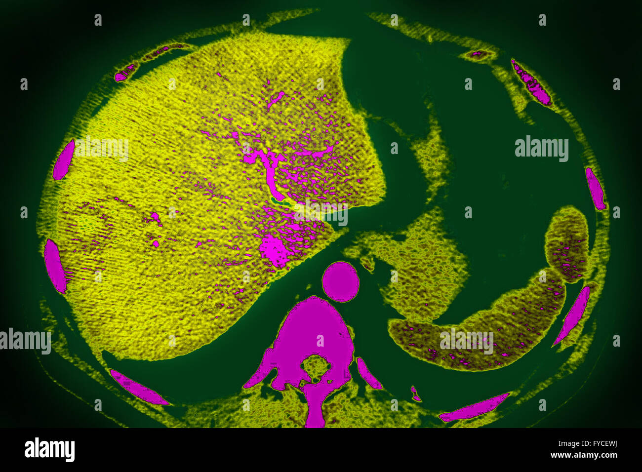 Human lymph glands hi-res stock photography and images - Alamy
