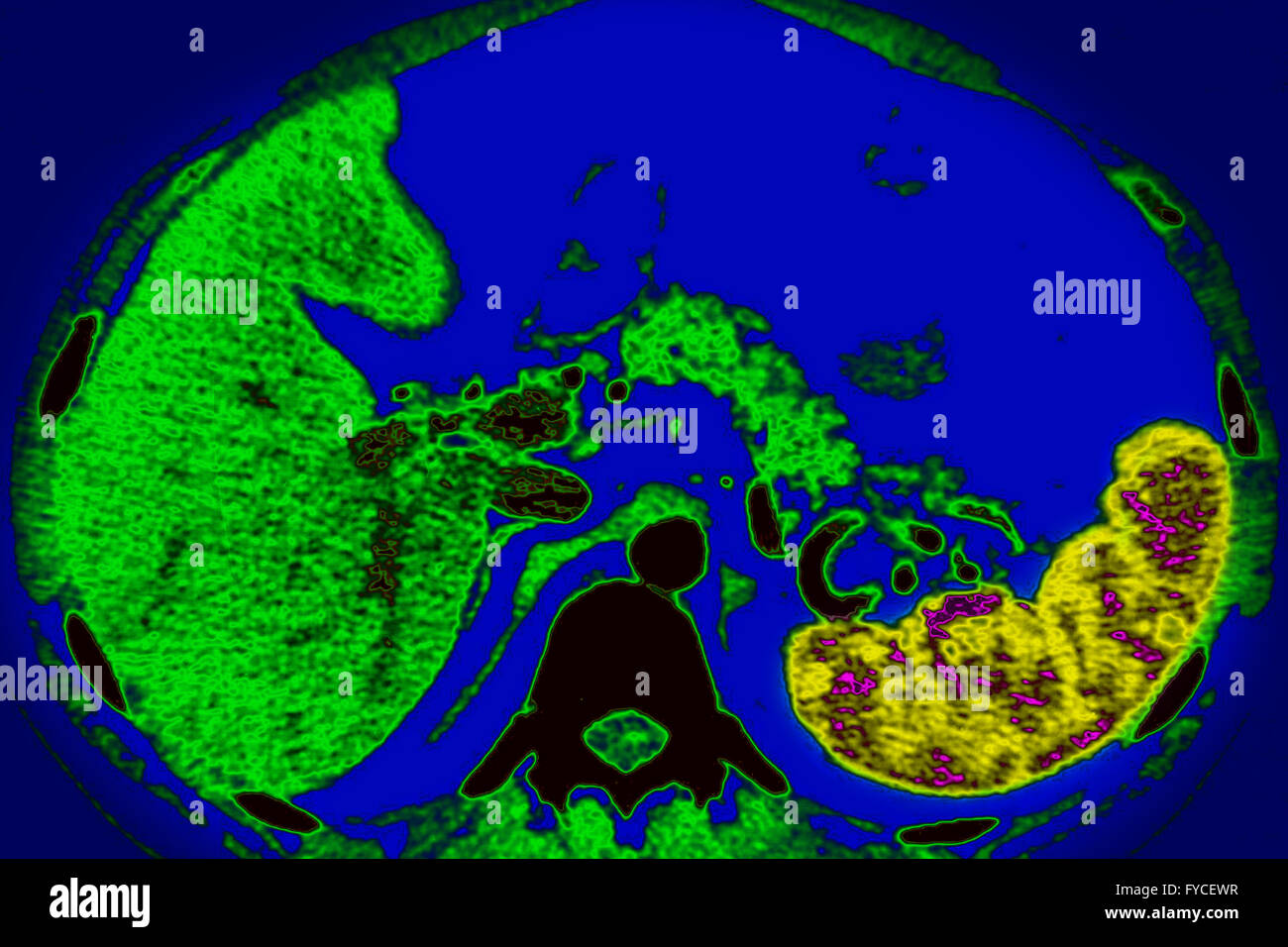 Abdominal Lymph Nodes High Resolution Stock Photography and Images - Alamy