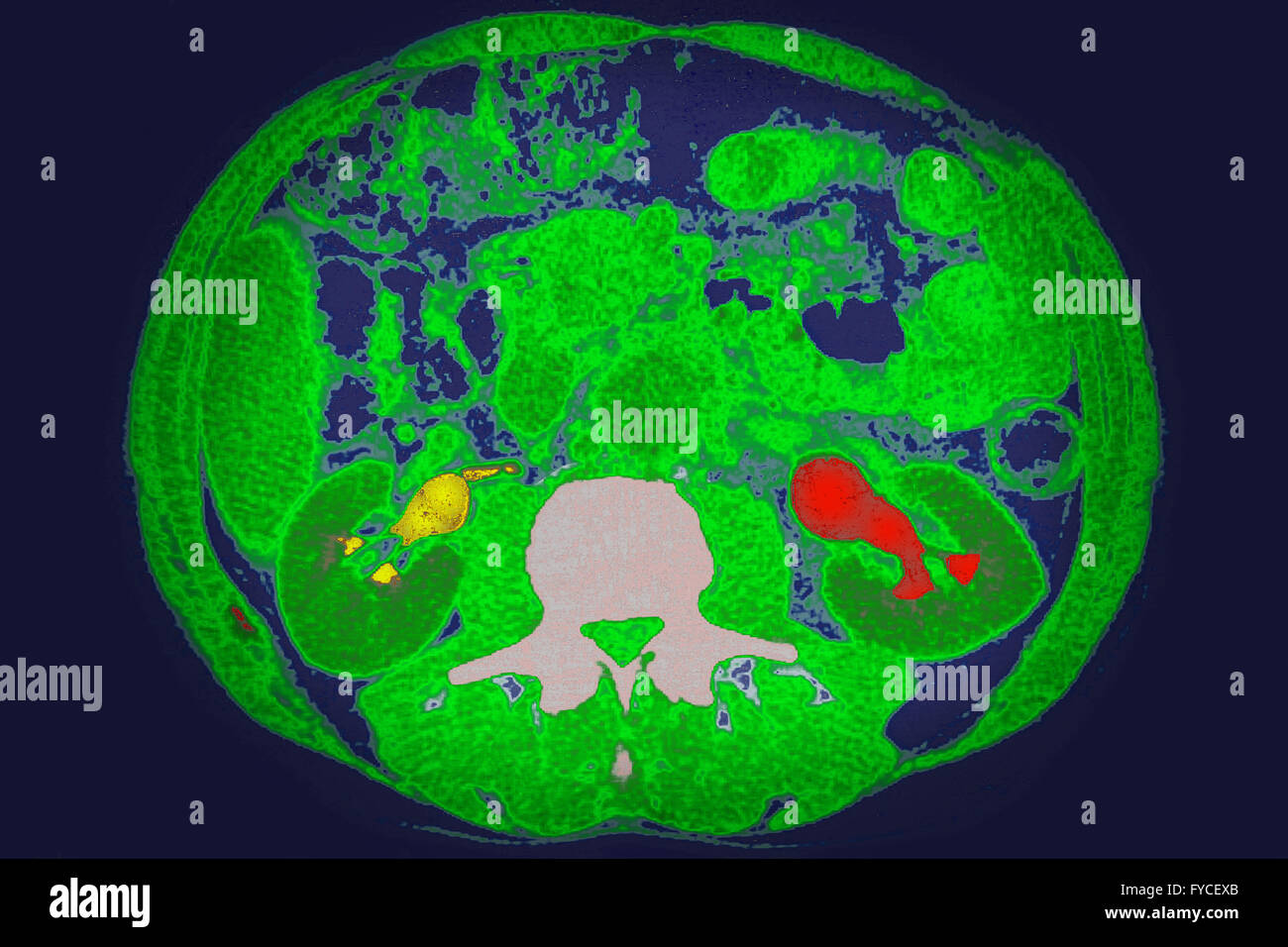 NEPHRITIC COLIC, SCAN Stock Photo - Alamy