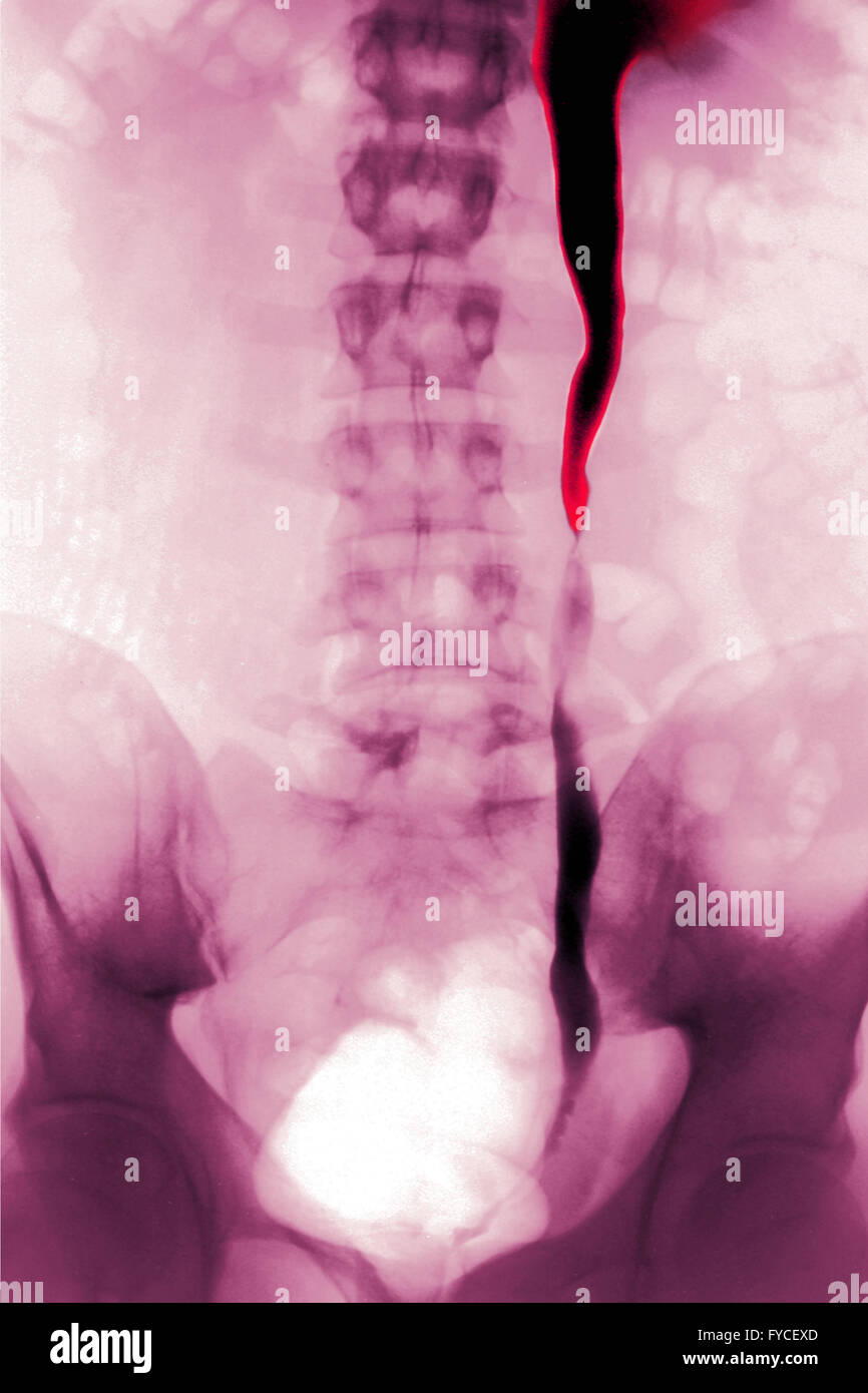 NEPHRITIC COLIC, X-RAY Stock Photo - Alamy