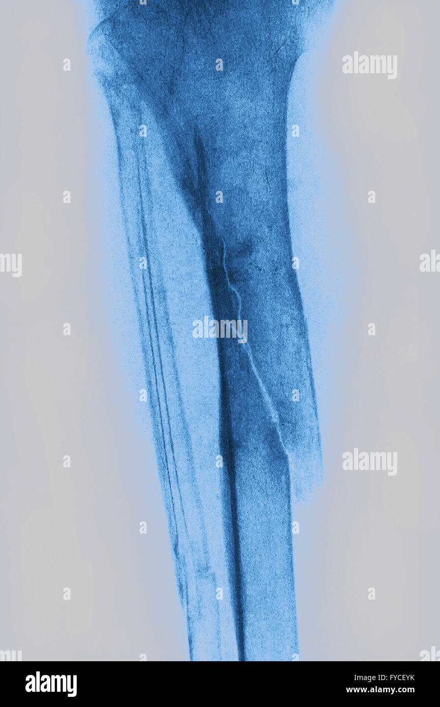 FRACTURED LEG, X-RAY Stock Photo - Alamy