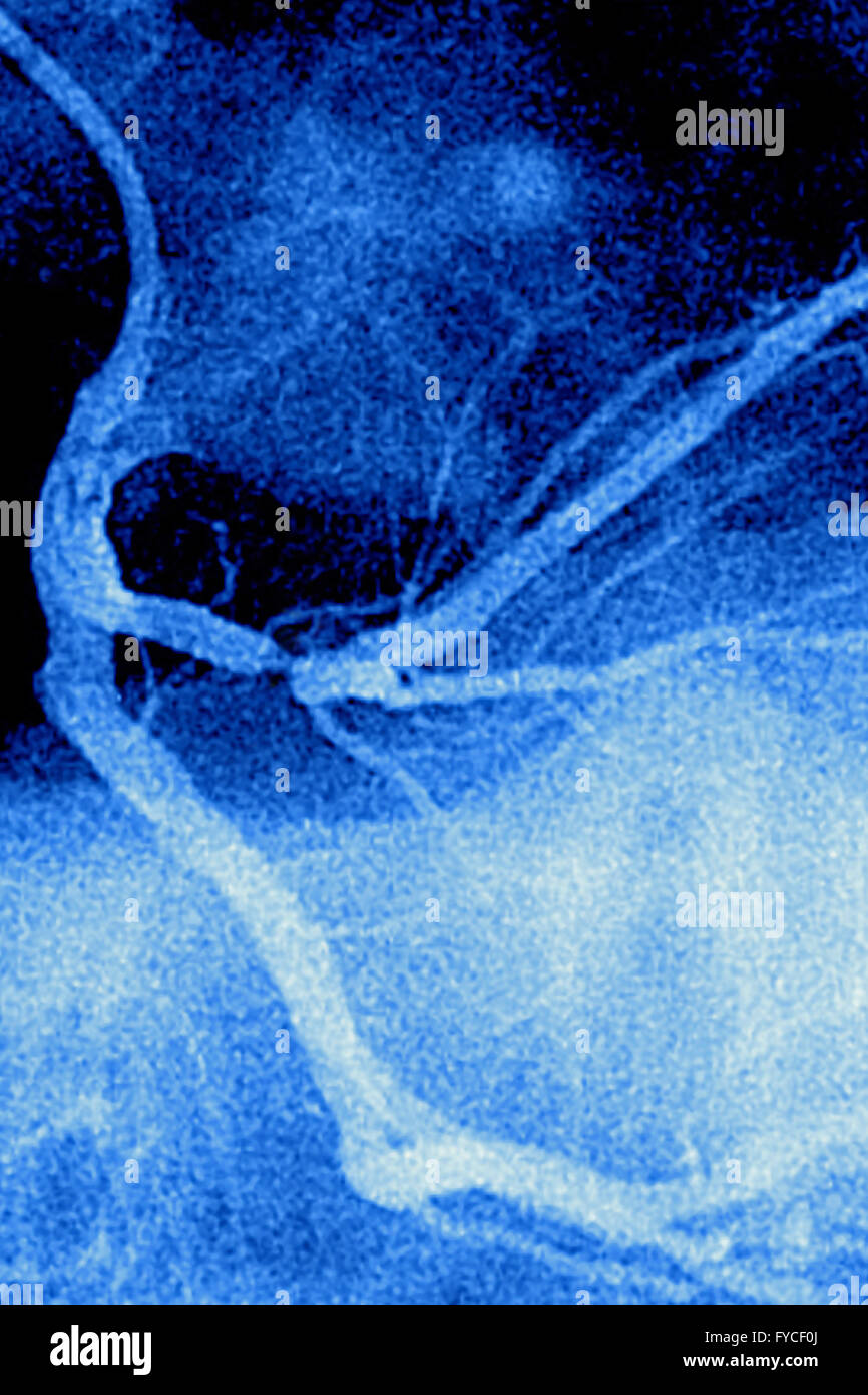 MYOCARDIAL INFARCTION, ANGIOGRAPHY Stock Photo - Alamy