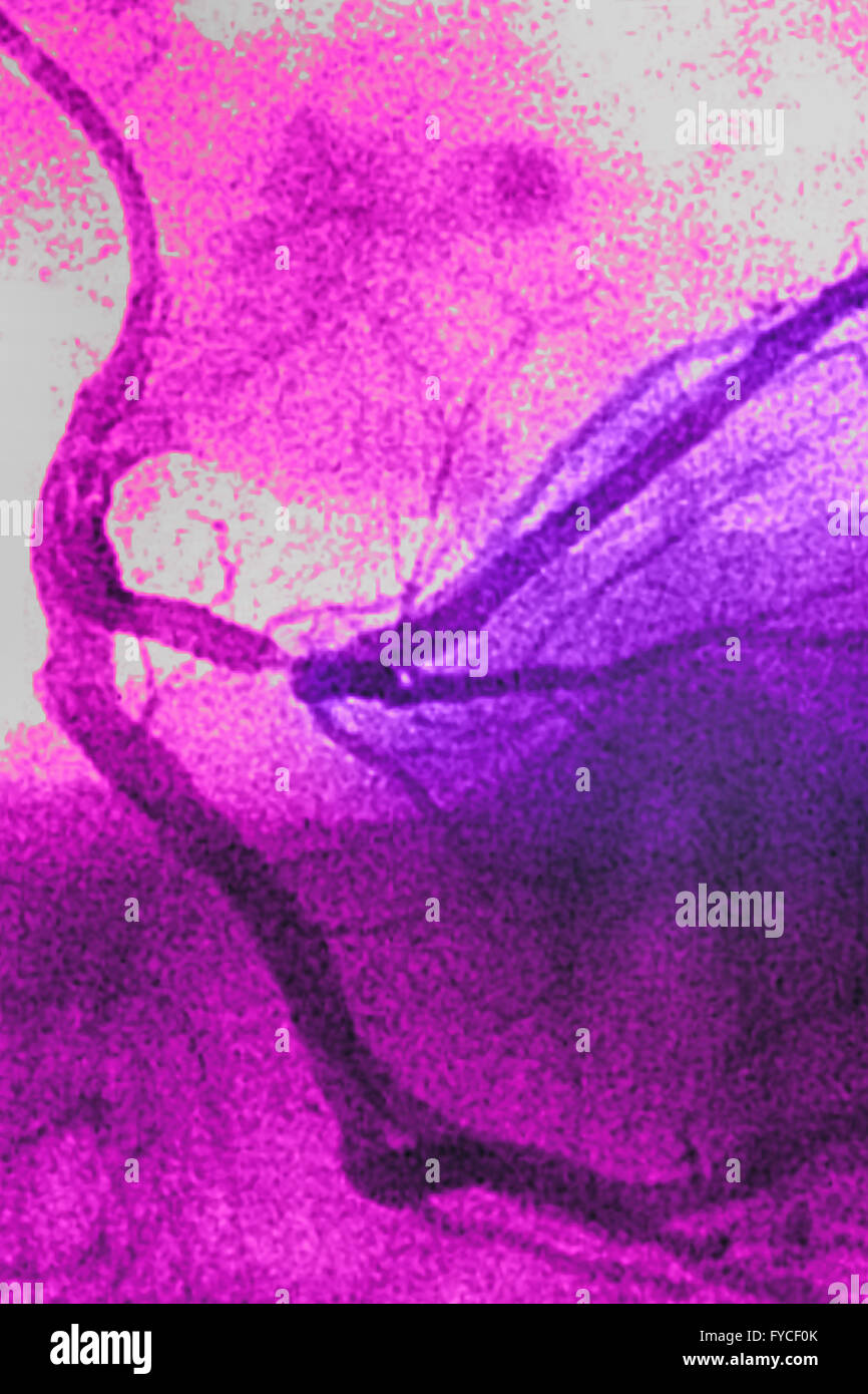 MYOCARDIAL INFARCTION, ANGIOGRAPHY Stock Photo - Alamy