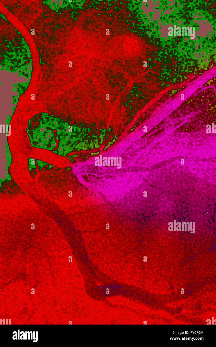 MYOCARDIAL INFARCTION, ANGIOGRAPHY Stock Photo - Alamy