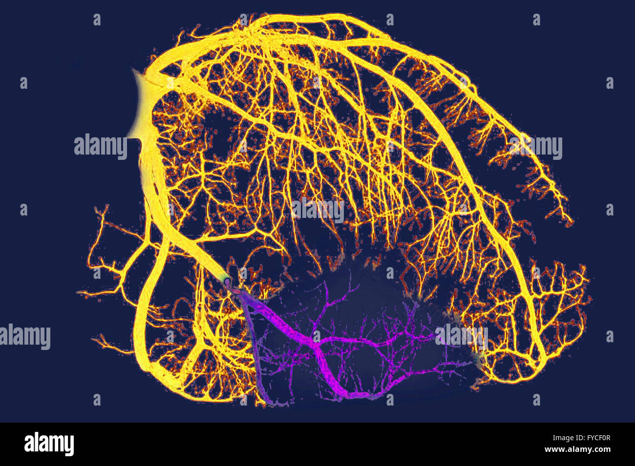 MYOCARDIAL INFARCTION, ILLUSTRATION Stock Photo - Alamy