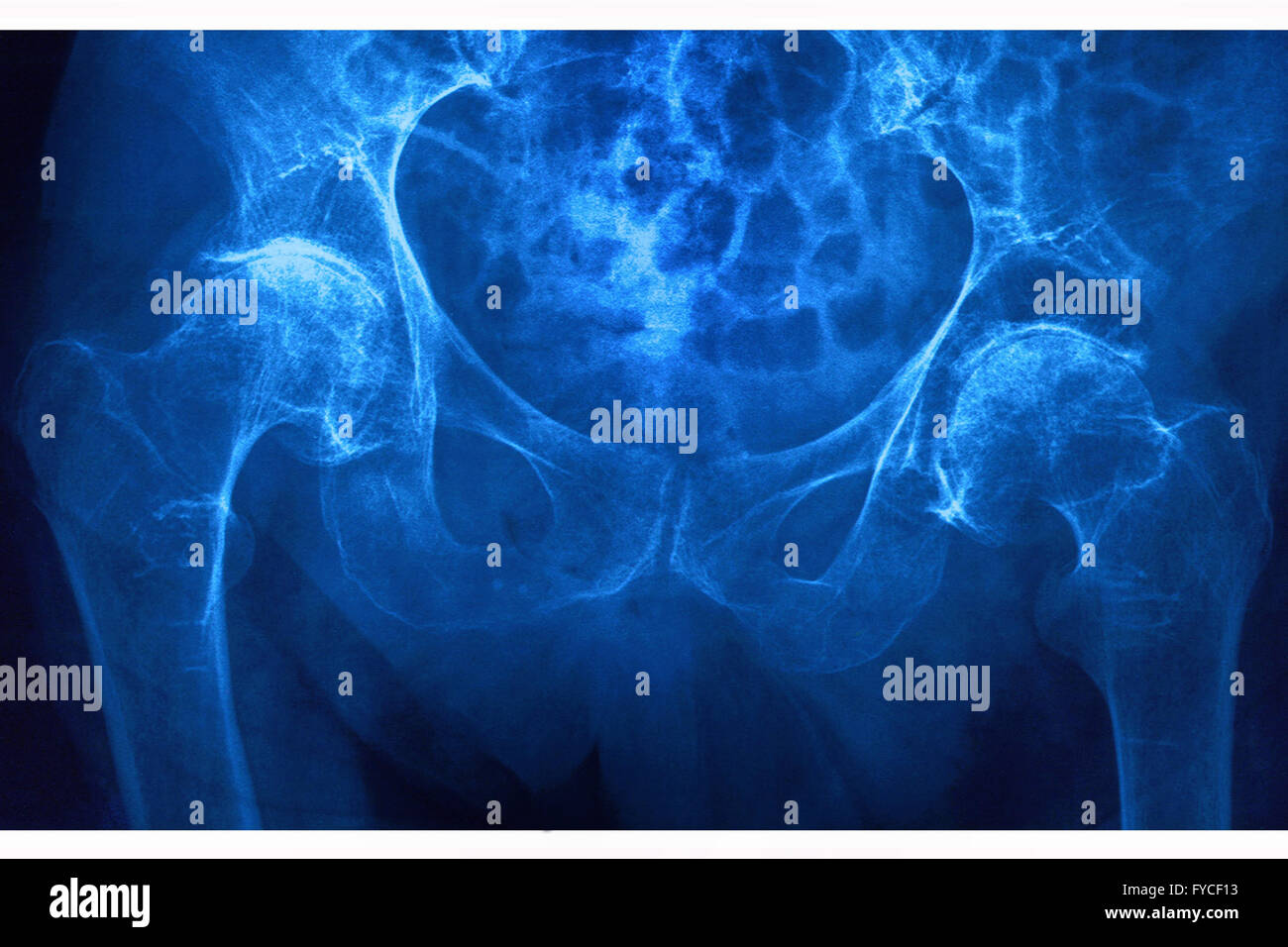 FRACTURED HIP, X-RAY Stock Photo - Alamy