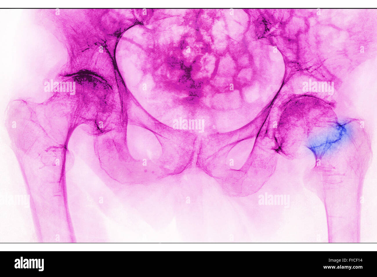 Hip fracture x ray hi-res stock photography and images - Alamy