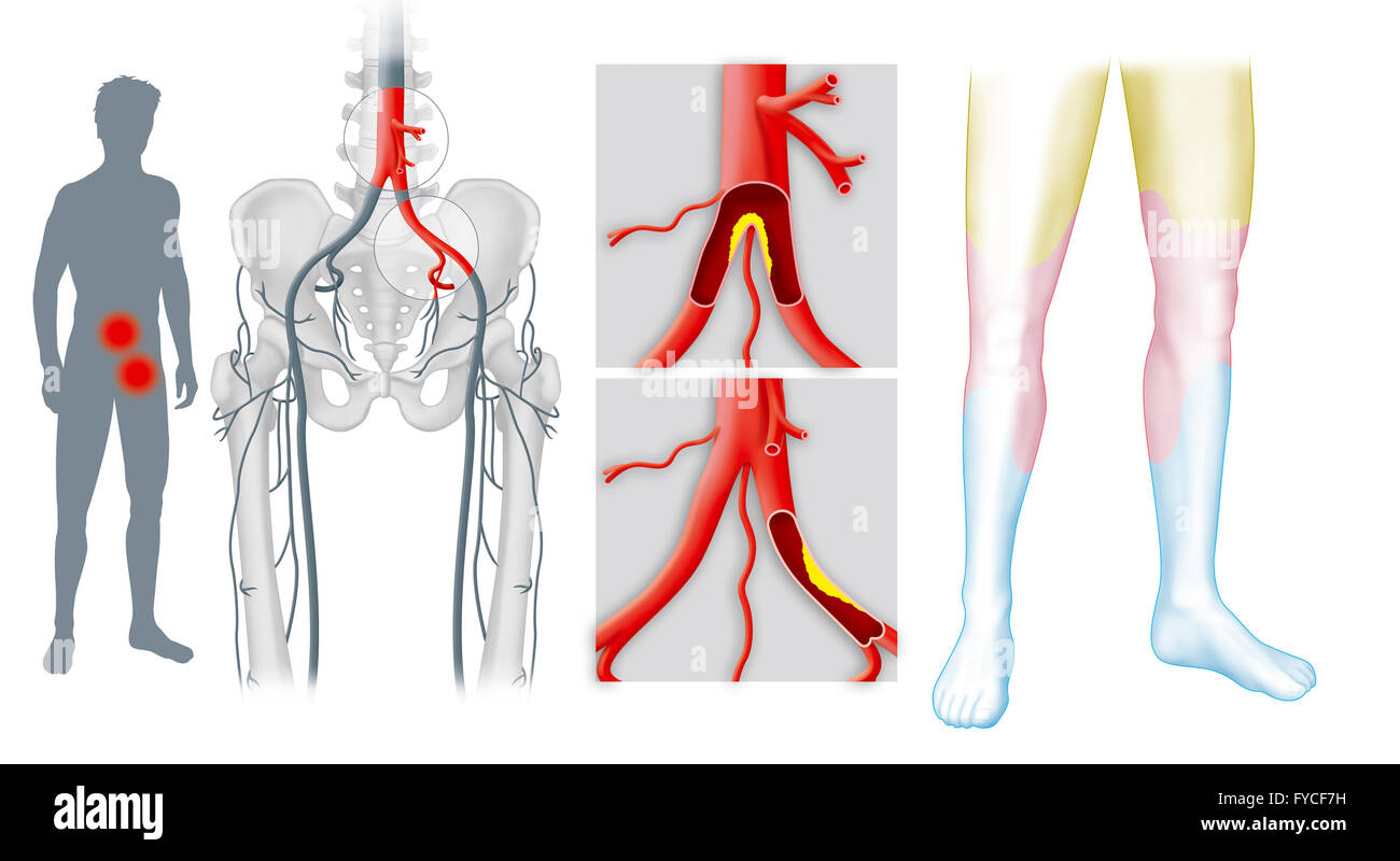 Aortic stenosis hi-res stock photography and images - Alamy