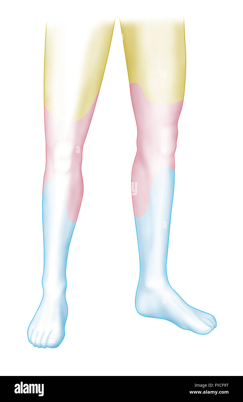 Vasculitis of legs hi-res stock photography and images - Alamy