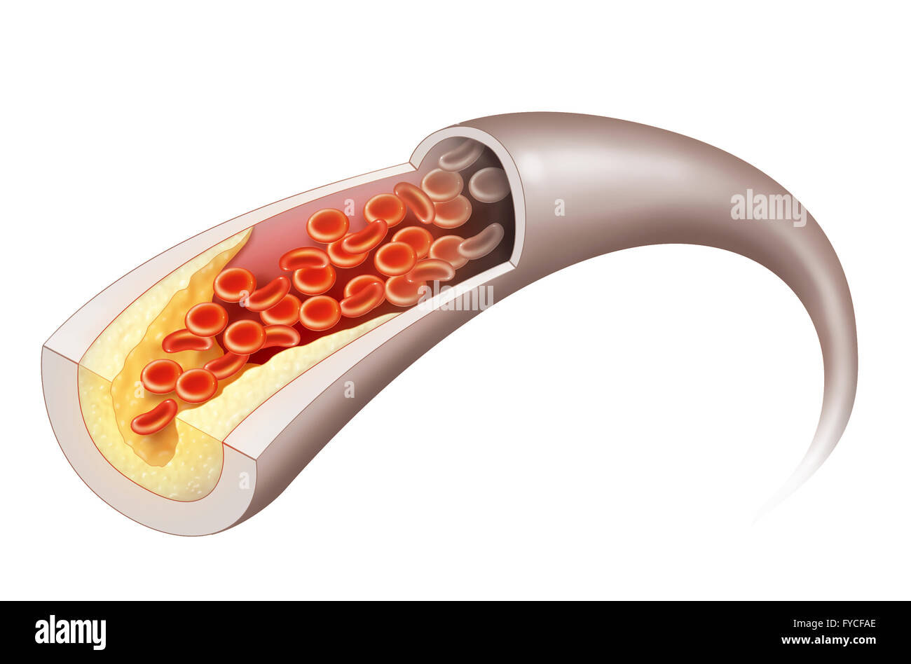 Arteriosclerosis drawing Cut Out Stock Images & Pictures - Alamy