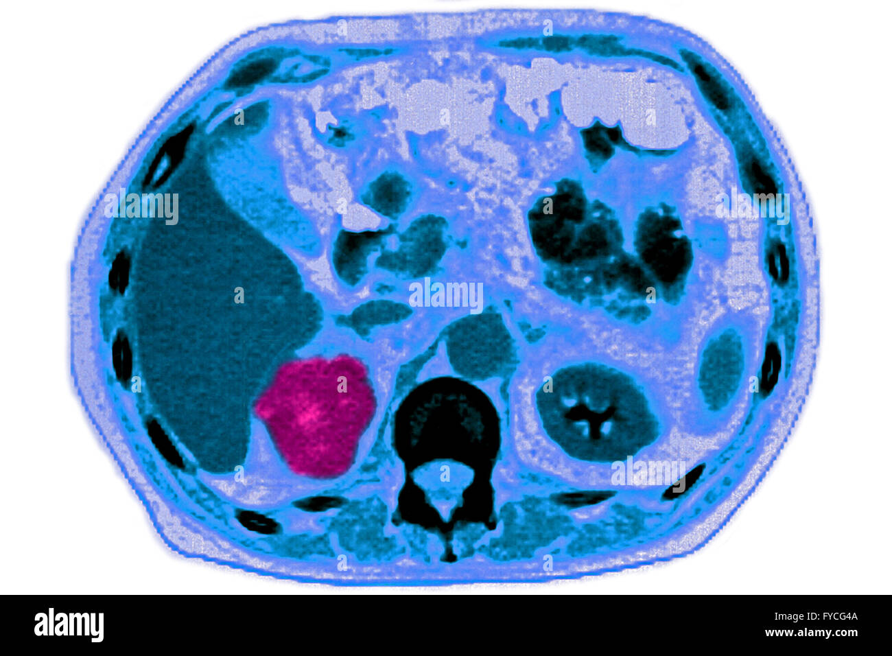 Ct of kidney cancer hi-res stock photography and images - Alamy