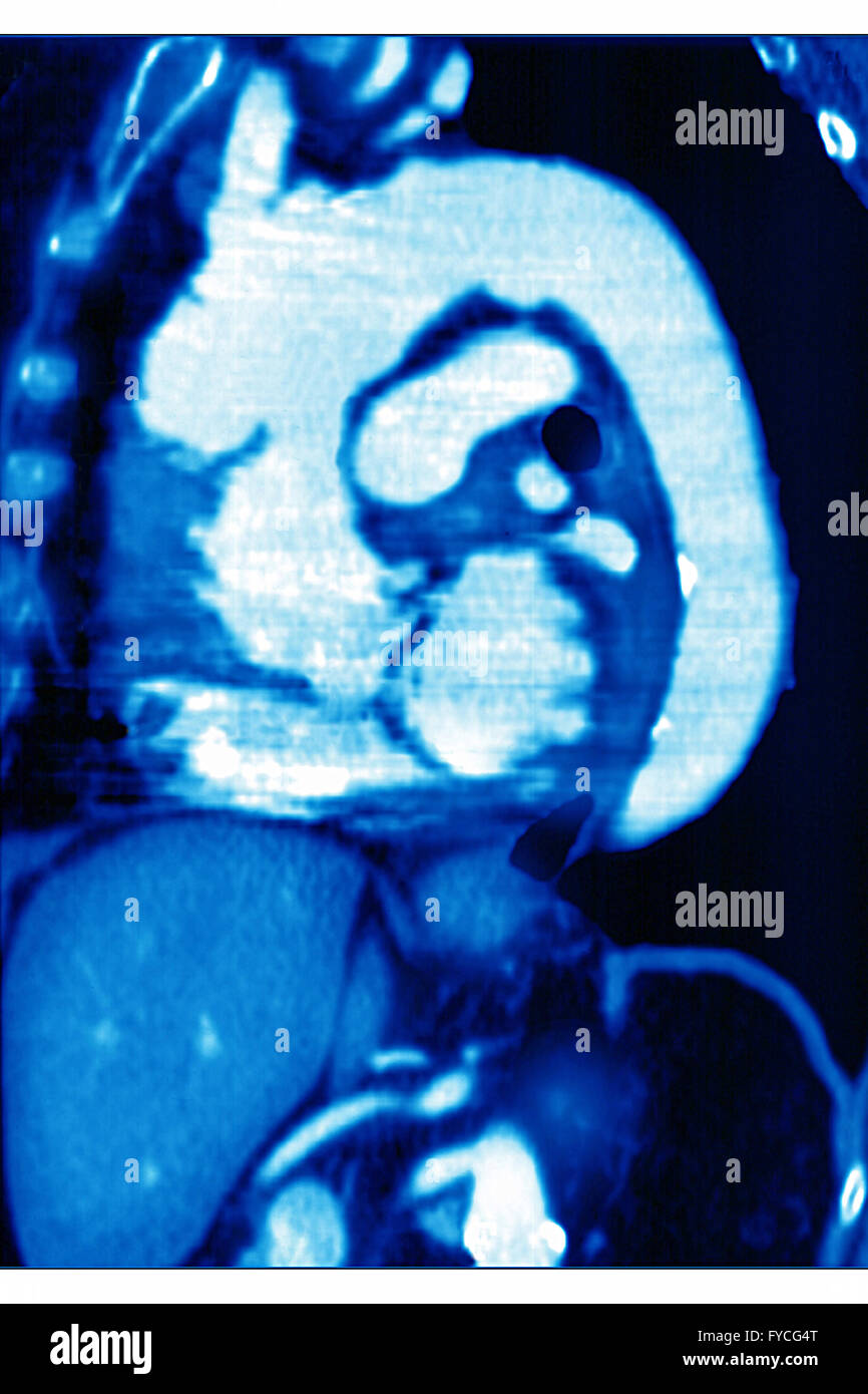 AORTIC DISSECTION, MRI Stock Photo - Alamy