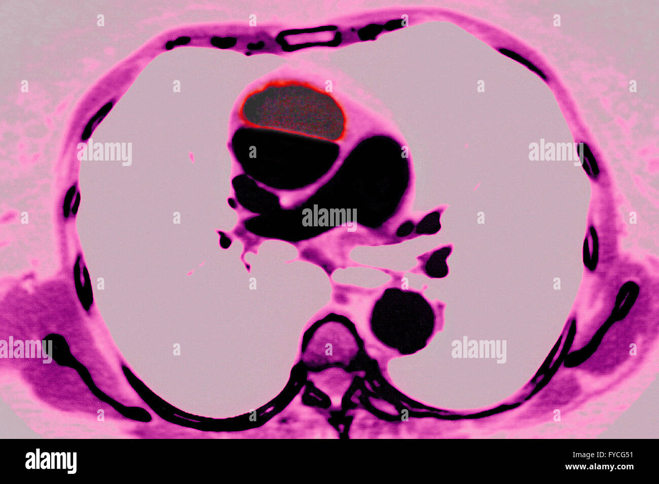 AORTIC DISSECTION, SCAN Stock Photo - Alamy