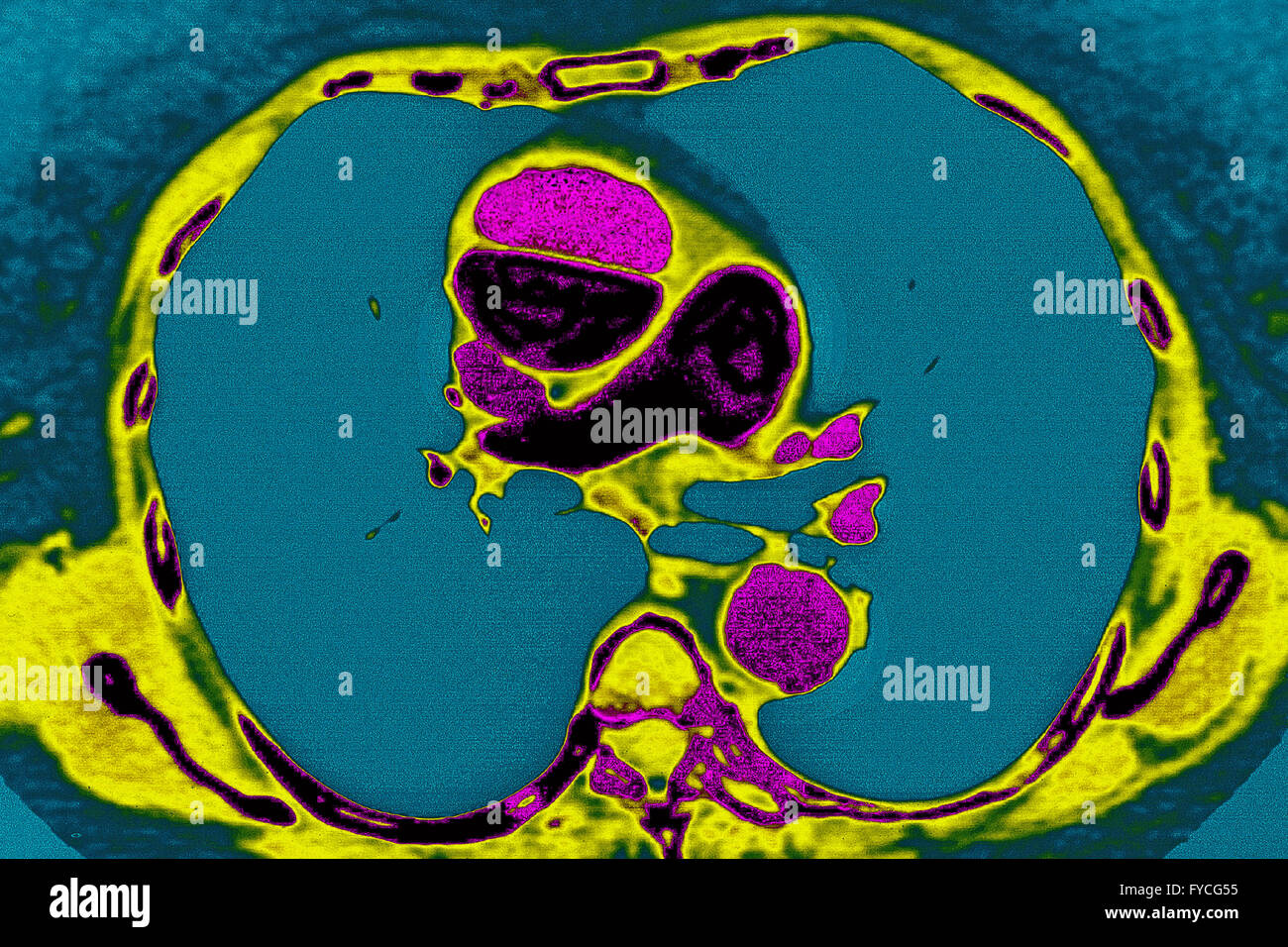 Aortic Dissection High Resolution Stock Photography and Images - Alamy