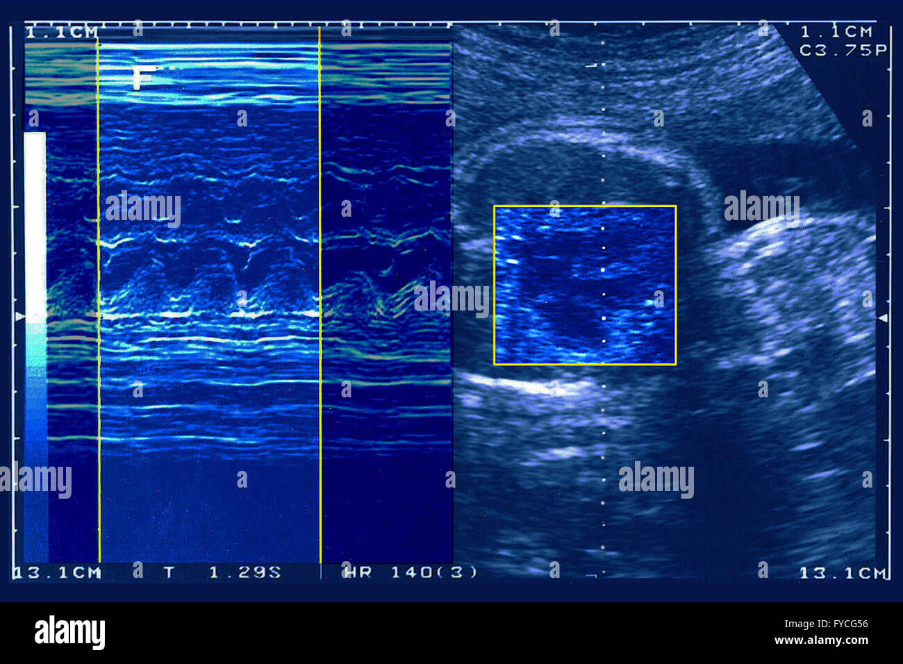 Fetus ultrasound 5 months hi-res stock photography and images - Alamy